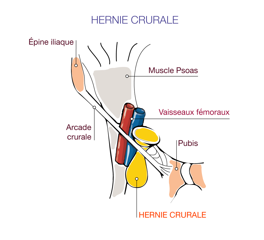 Chirurgie de la paroi abdominale