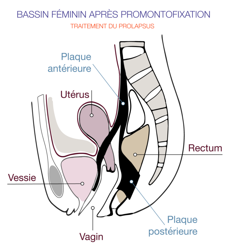 Chirurgie proctologique