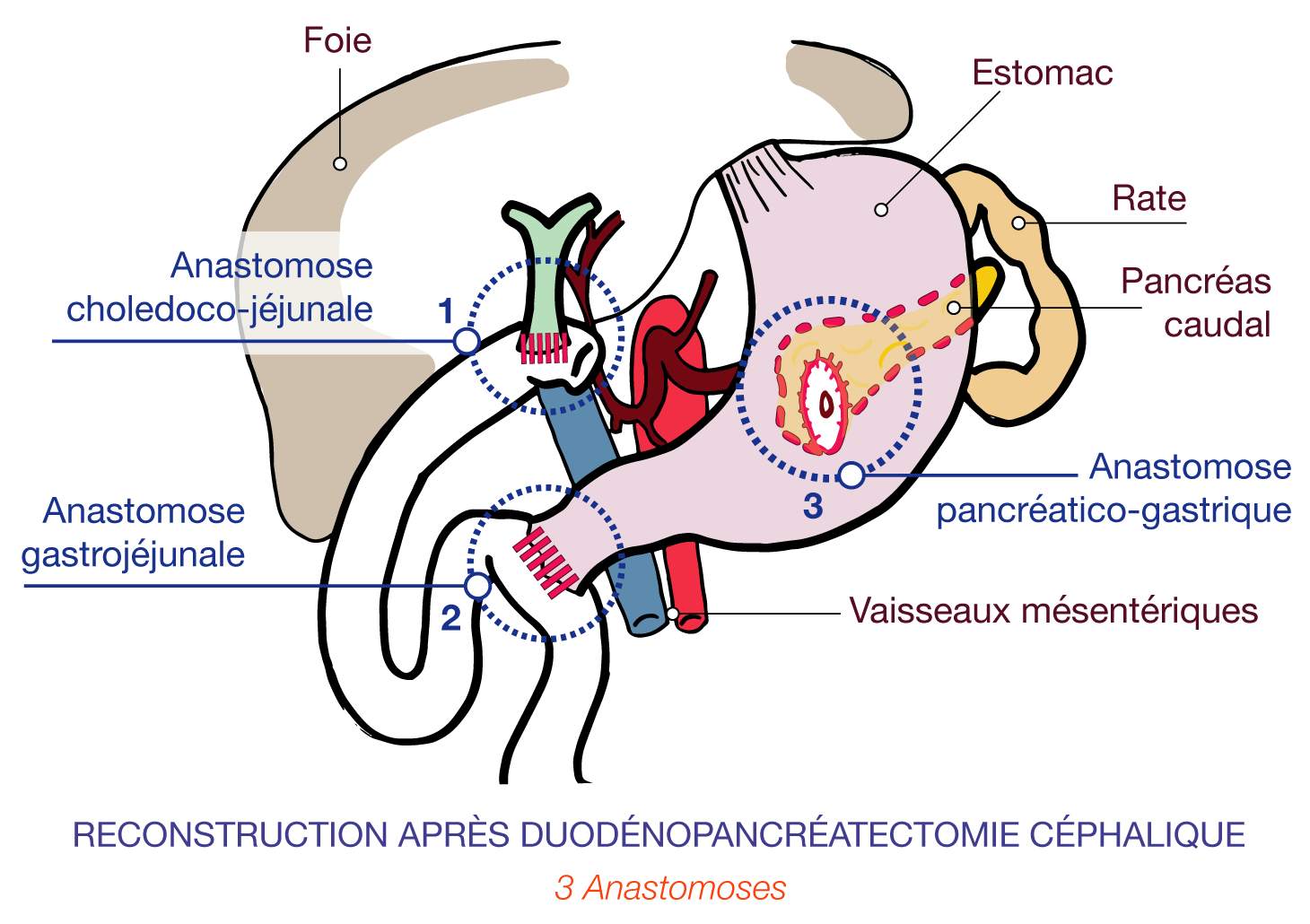 Chirurgie des cancers
